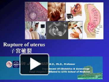 Rupture of uterus ???? presentation | free to view