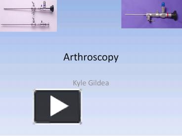 Arthroscopy presentation | free to download