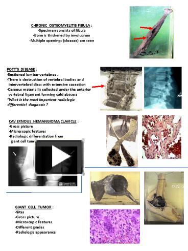 PPT – CHRONIC OSTEOMYELITIS FIBULA : -Specimen consists of fibula -Bone ...