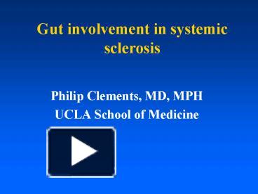 PPT – Gut involvement in systemic sclerosis PowerPoint presentation ...