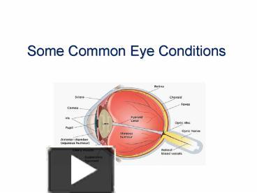 Some Common Eye Conditions presentation | free to view
