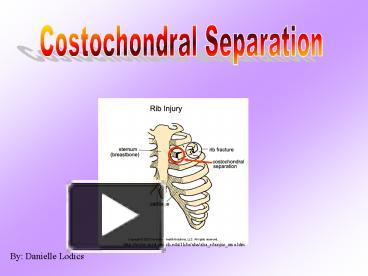 Costochondral Separation The Sternum: Anatomy And 3D Illustrations