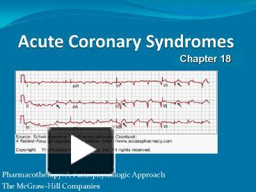 PPT – Acute Coronary Syndromes Chapter 28 PowerPoint presentation ...