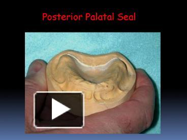 PPT – Posterior Palatal Seal PowerPoint presentation | free to view ...