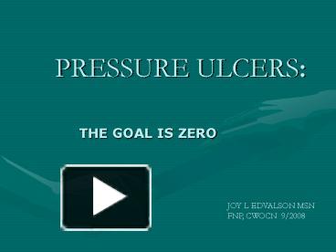 PPT – PRESSURE ULCERS: PowerPoint presentation | free to view - id ...