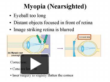Myopia (Nearsighted) presentation | free to view