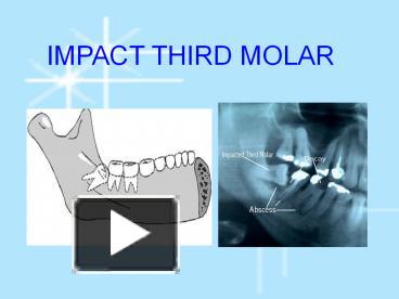 PPT – IMPACT THIRD MOLAR PowerPoint presentation | free to view - id ...