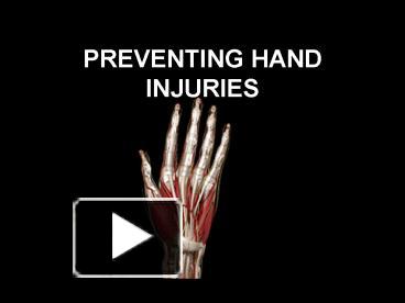 PPT – PREVENTING HAND INJURIES PowerPoint presentation | free to view ...