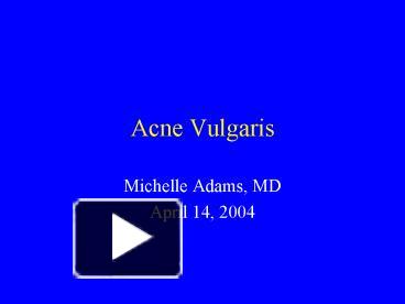 Acne Vulgaris presentation | free to view