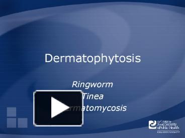 Dermatophytosis presentation | free to download