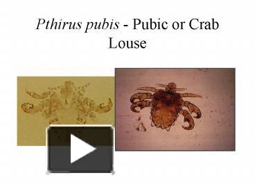 Pthirus pubis Pubic or Crab Louse presentation | free to view
