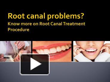 PPT – Root canal problems? Know more on Root Canal Treatment Procedure ...