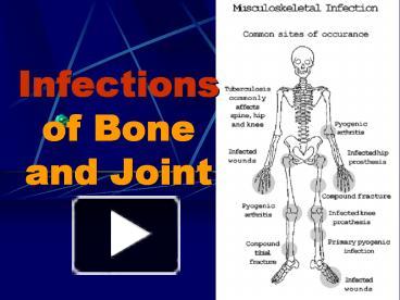Infections of Bone and Joint presentation | free to view
