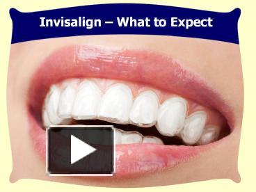PPT – Invisalign San Diego- Invisalign: What to expect PowerPoint ...