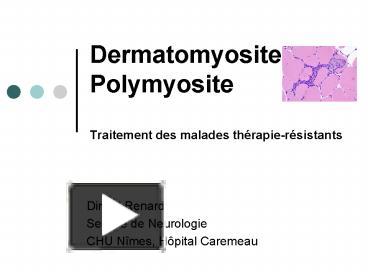 Dermatomyosite Polymyosite Traitement des malades th presentation ...