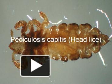 ?? Pediculosis capitis (Head lice) presentation | free to download