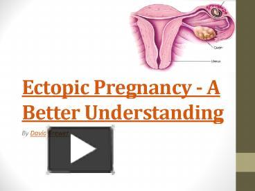 Ectopic Pregnancy - A Better Understanding presentation | free to download