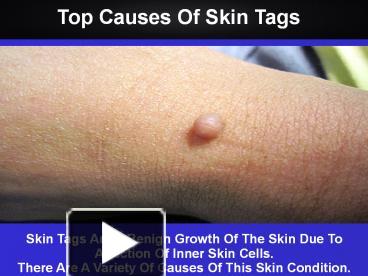 PPT – Top Causes Of Skin Tags PowerPoint presentation | free to view ...