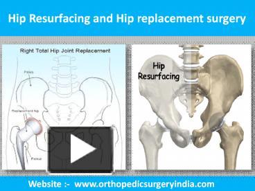 PPT – Hip resurfacing surgery in Delhi PowerPoint presentation | free ...
