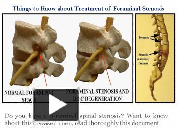 Treatment of Foraminal Stenosis presentation | free to download