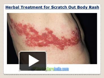 PPT – Herbal Treatment for Scratch Out Body Rash PowerPoint ...