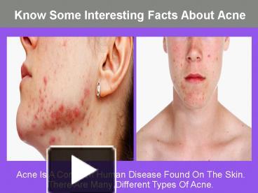 Know Some Interesting Facts About Acne presentation | free to download