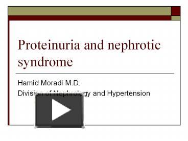 Proteinuria and nephrotic syndrome presentation | free to view