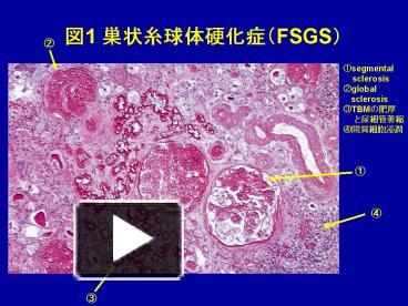 PPT – ?1 ????????(FSGS) PowerPoint presentation | free to download - id ...