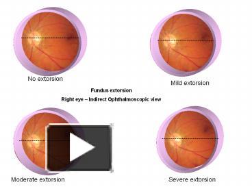 Fundus%20extorsion presentation | free to download
