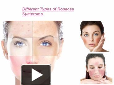 Different Types of Rosacea Symptoms presentation | free to download