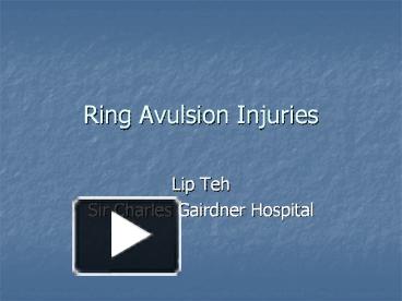 PPT – Ring Avulsion Injuries PowerPoint presentation | free to view ...