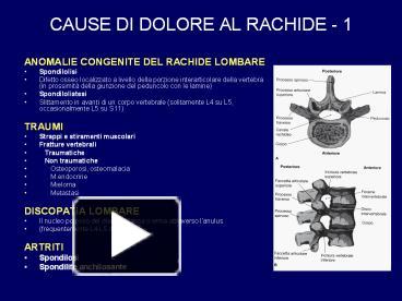 CAUSE DI DOLORE AL RACHIDE - 1 presentation | free to view