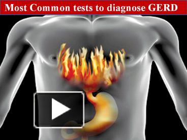 PPT – Most Common tests to diagnose GERD PowerPoint presentation | free ...