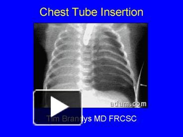 Chest Tube Insertion presentation | free to view