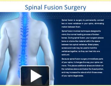 Spinal Fusion Surgery presentation | free to download
