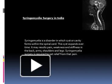PPT – Syringomyelia Treatment in India PowerPoint presentation | free ...