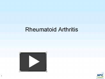 PPT – Rheumatoid Arthritis PowerPoint presentation | free to view - id ...