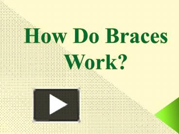 PPT – How Do Braces Work? PowerPoint presentation | free to download ...