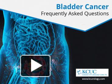 PPT – Bladder Cancer - Questions and Detailed Answers! (2) PowerPoint ...