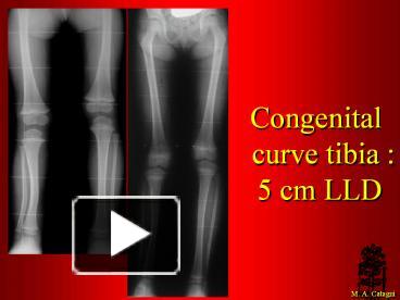 PPT – Congenital curve tibia : PowerPoint presentation | free to view ...