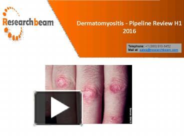 Dermatomyositis Causes and Symptoms – Overview presentation | free to ...