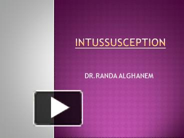 INTUSSUSCEPTION presentation | free to view