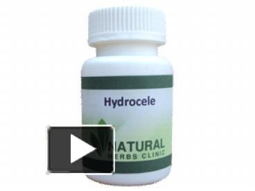 PPT – Hydrocele Natural Treatment Option PowerPoint presentation | free ...