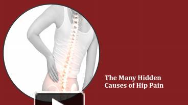 PPT – The Many Hidden Causes of Hip Pain PowerPoint presentation | free ...