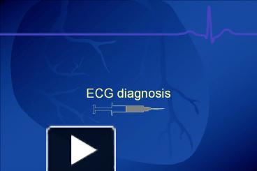 ECG diagnosis presentation | free to view