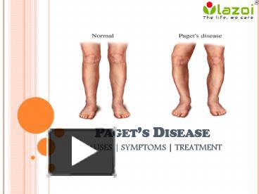 Paget’s disease : causes, symptoms, diagnosis and treatment ...
