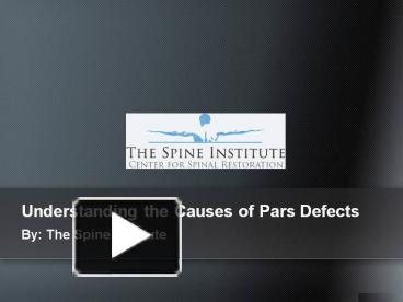 PPT – Understanding the Causes of Pars Defects PowerPoint presentation ...