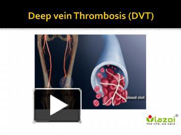 Deep vein Thrombosis (DVT) presentation | free to download