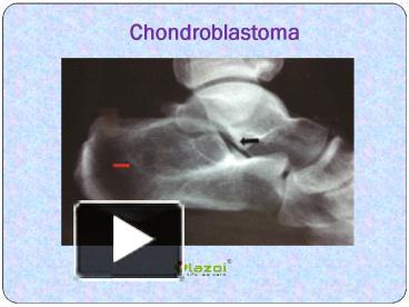 PPT – Chondroblastoma: Symptoms, Causes, Diagnosis and Treatment ...