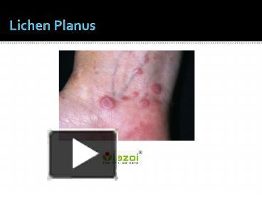 Lichen Planus: Symptoms, Causes, Diagnosis and Treatment presentation ...